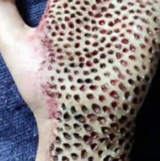 Is There a Recently Discovered Lethal Insect Species that Creates ...