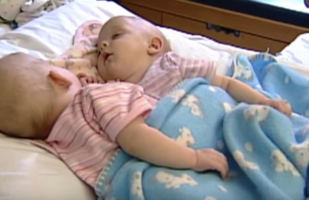 Conjoined twins were connected from birth, but surgery permanently ...