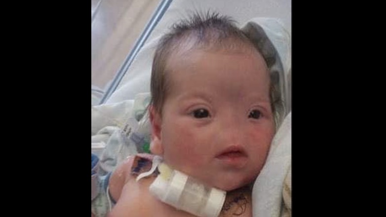 Born Without A Nose, Here’s What Tessa Evans Looks Like At 10 ...